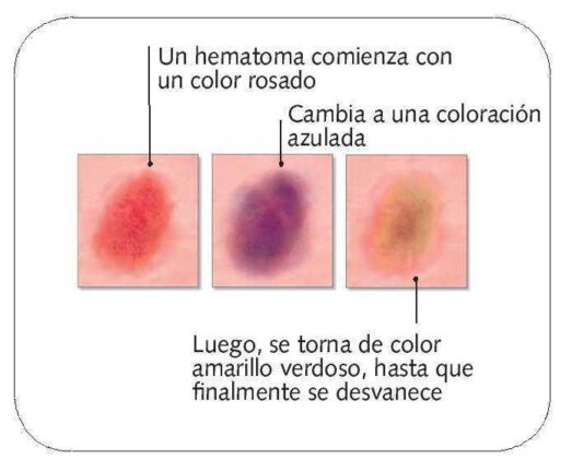 ¿Que hacer en caso de contusiones? - El Men